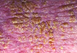 Aspectos Clínicos y de Diagnóstico de la Pioderma Canina – VetPraxis