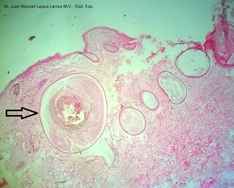 QUISTES EPIDÉRMICOS: Descripción Histopatológica y Citológica para los ...