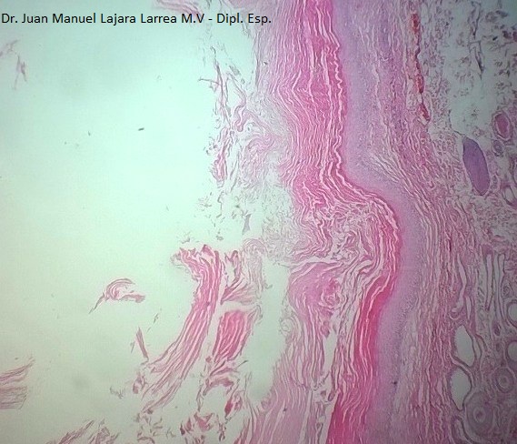 QUISTES EPIDÉRMICOS: Descripción Histopatológica y Citológica para los ...
